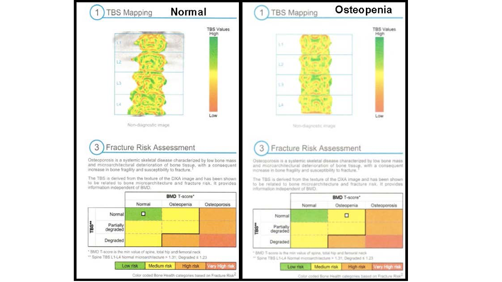 Importanza del Trabecular Bone Score (TBS) nello studio con MOC DEXA dell'osteoporosi ...